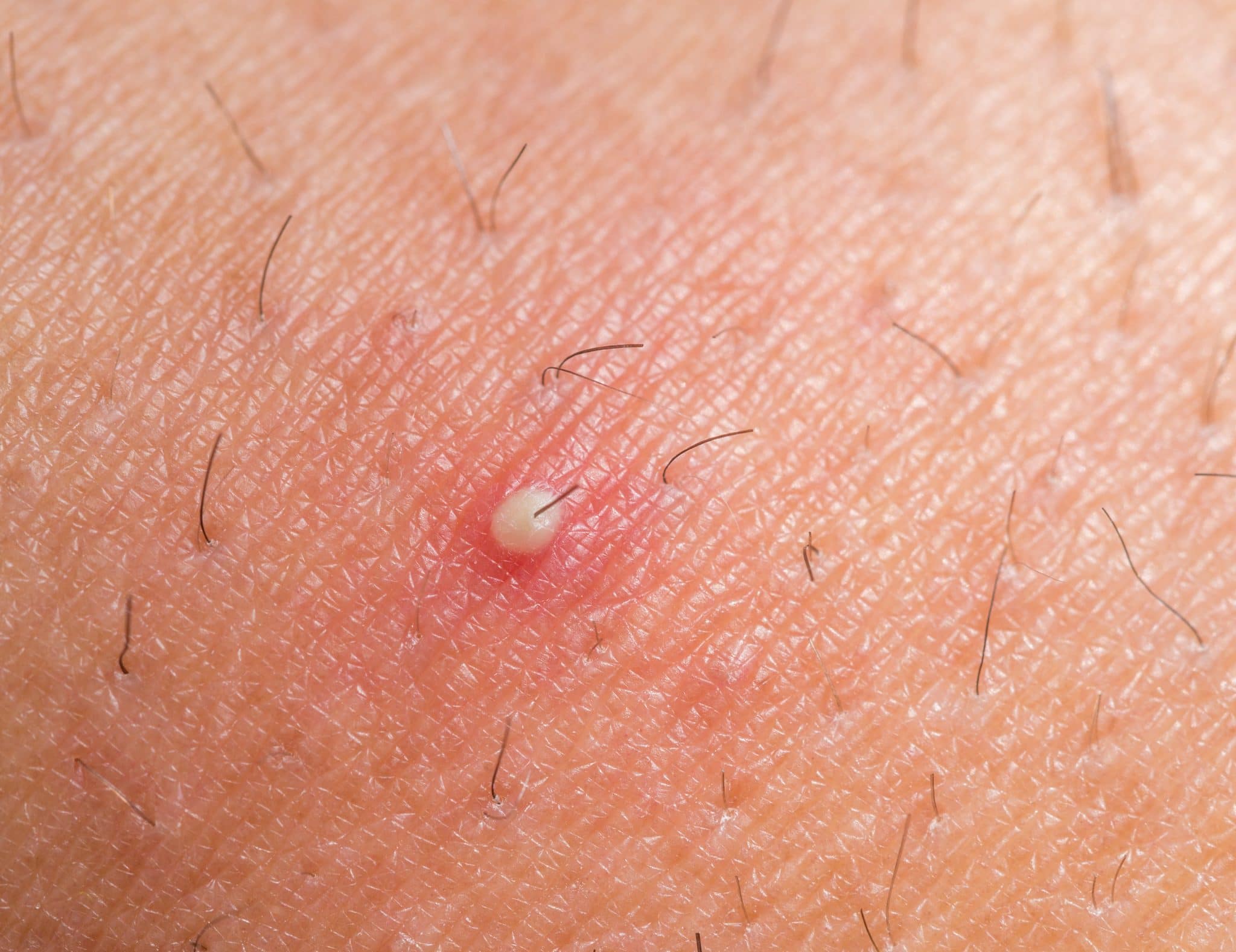 Das hilft gegen eingewachsene Haare: 5 Tipps Das hilft gegen eingewachsene Haare: 5 Tipps