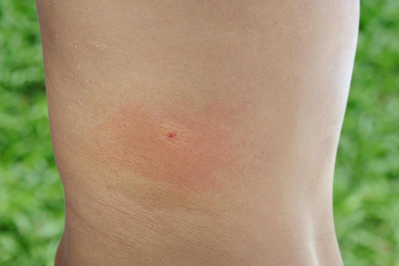 Wespe, Gelse oder doch Bremse? Dieses Insekt hat dich gestochen